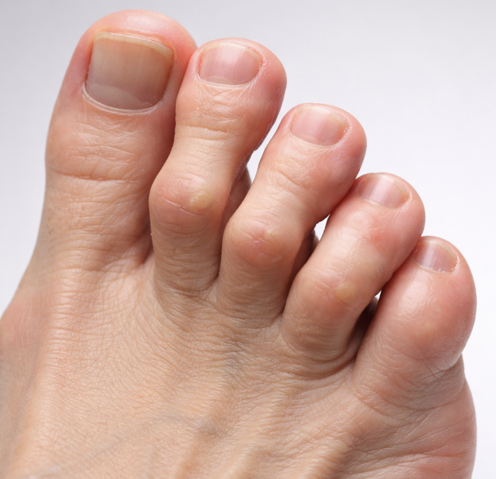 How to Fix Hammer Toes: Causes, Treatment & Prevention - Newman Feet